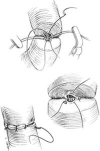 vasectomy procedure code ireland