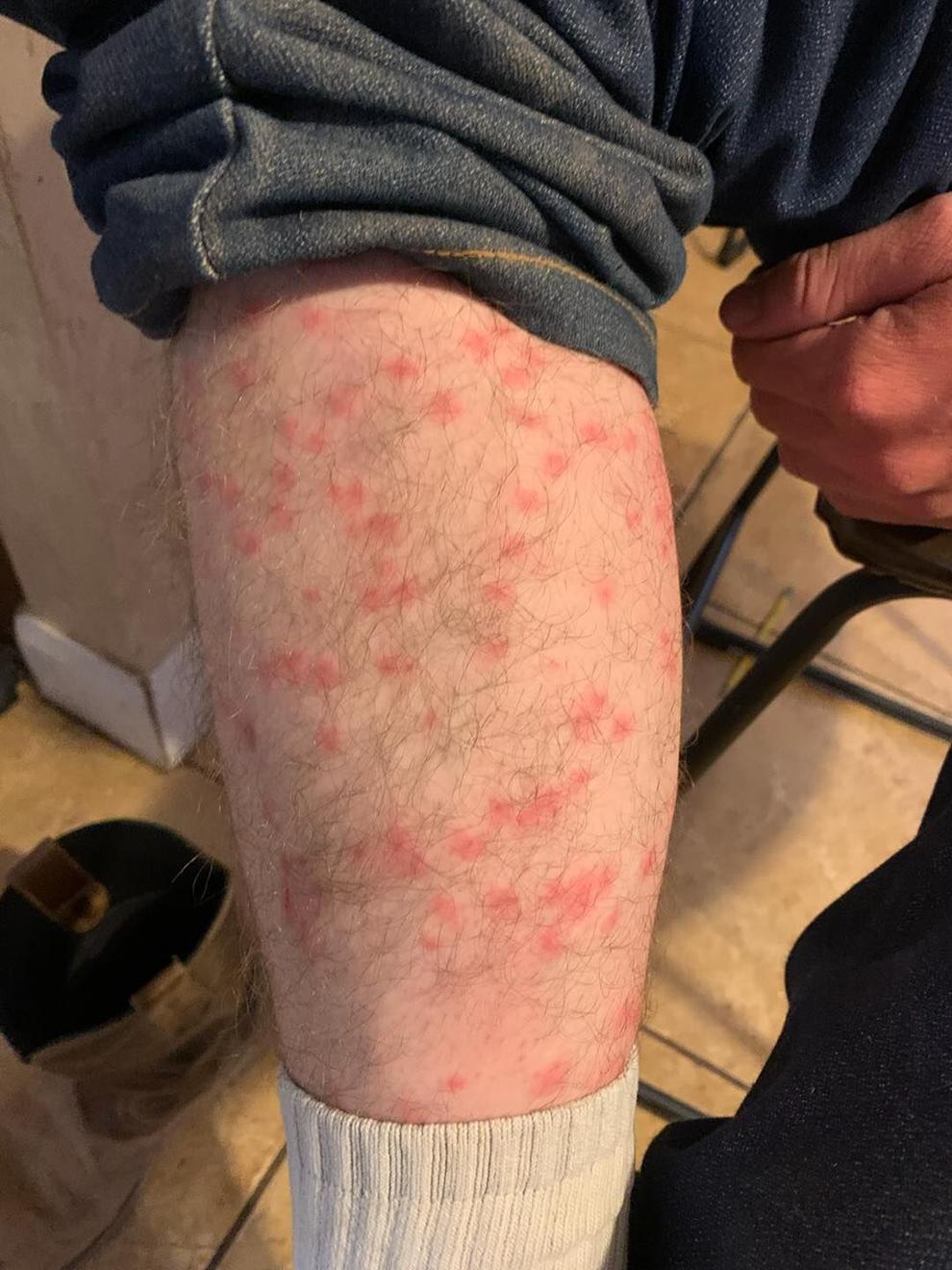 Parasite causing swimmer’s itch returns to Sand Hollow. What can you do ...