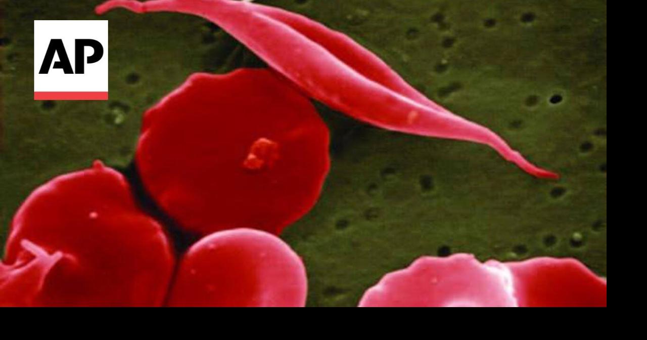 Two gene therapies for sickle cell disease approved in US ...