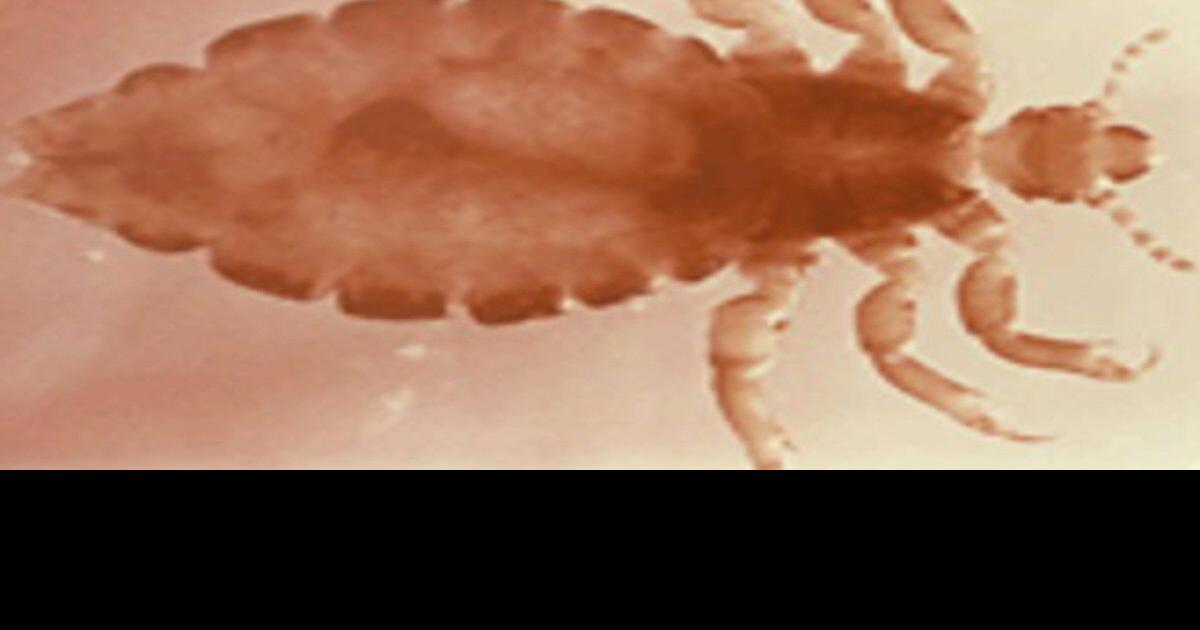 5Ws+1H: What It's About: Nip nits in bud before they're lice | News ...