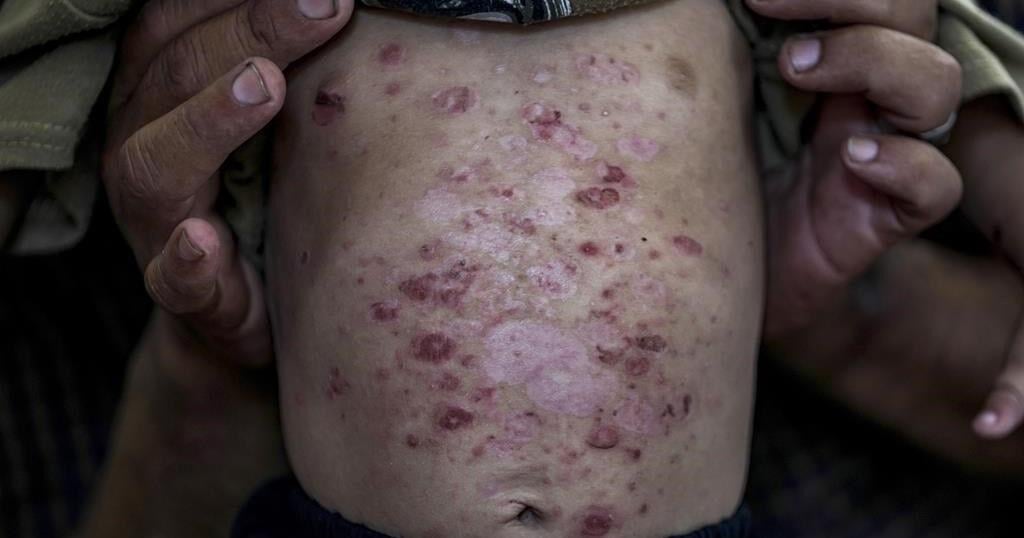 Lice, scabies, rashes plague Palestinian children as skin disease runs ...