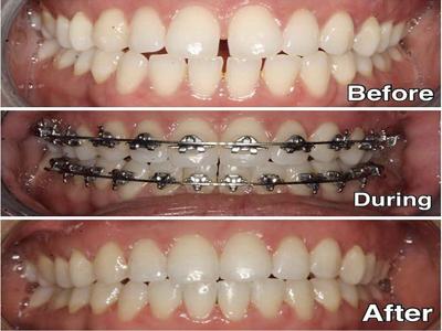 The unique technology and benefits of Fastbraces for adults | The ...