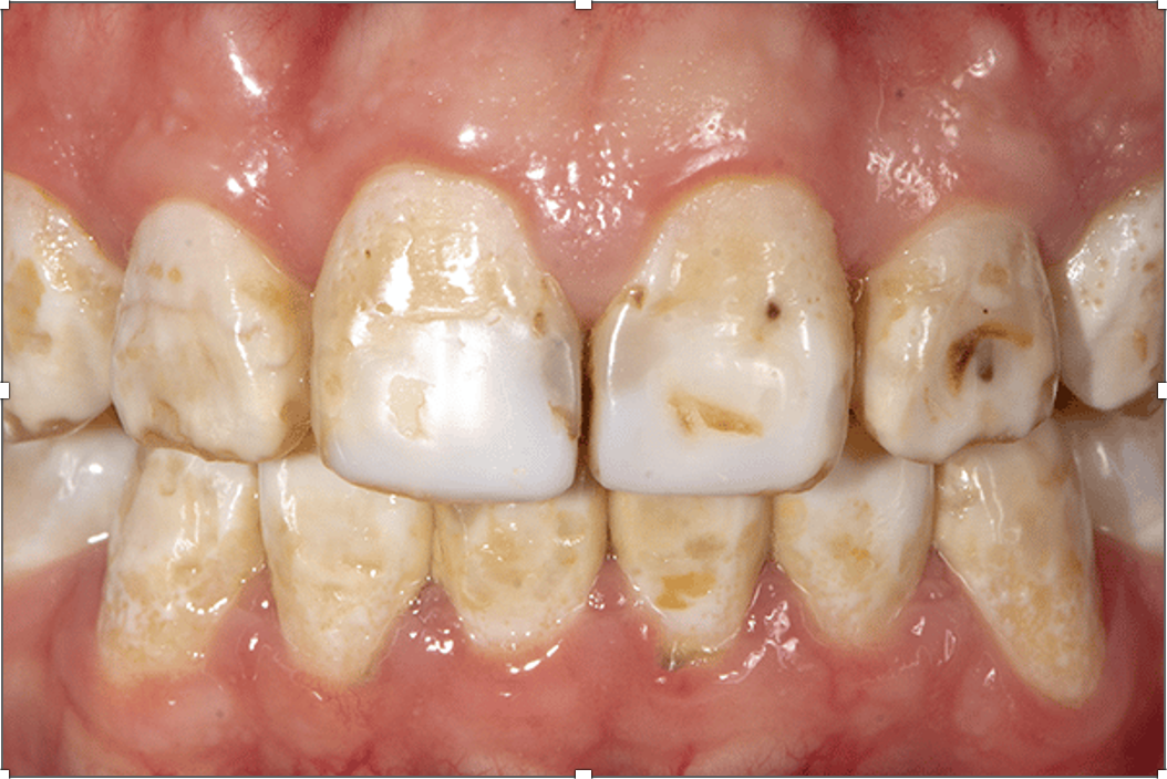 The role of fluoride in dentistry and its impact on tooth decay ...