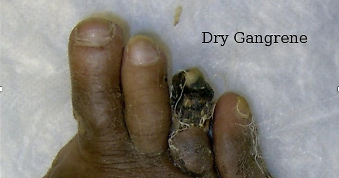 Gangrene can quickly spread to other areas of the body if left ...