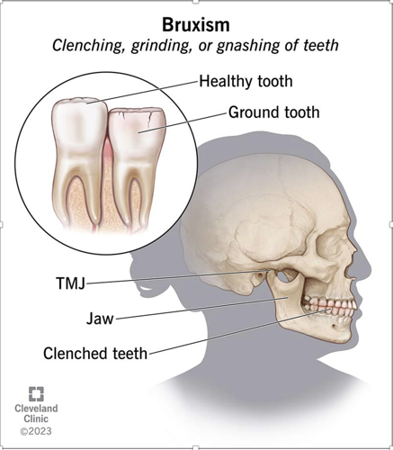 Managing bruxism: Understanding teeth grinding, clenching and trauma ...