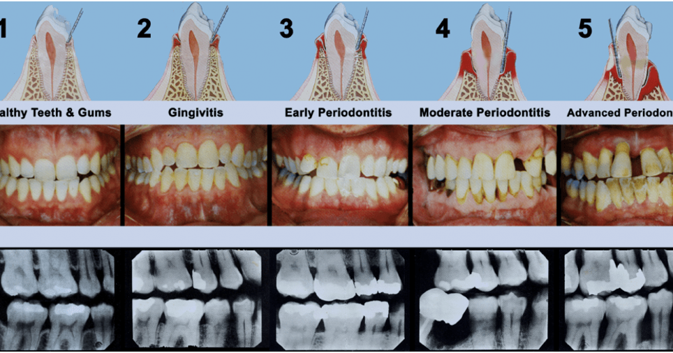 Understanding gum disease: Don't wait until it hurts | The Specialist ...