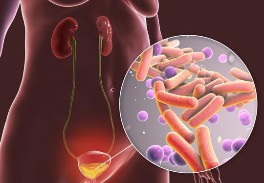 Not every UTI is 'just a urinary tract infection' | Lifestyles ...