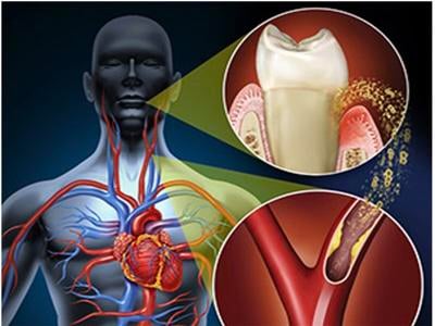 Your gums: a predictor of heart disease | The Specialist ...