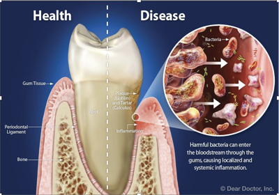 Your gums and your brain: The surprising link to Alzheimer's disease ...