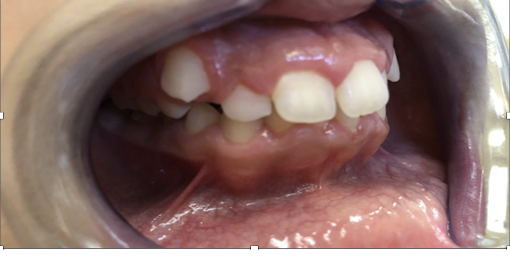 Fastbraces technology: Redefining orthodontic treatment with speed and ...