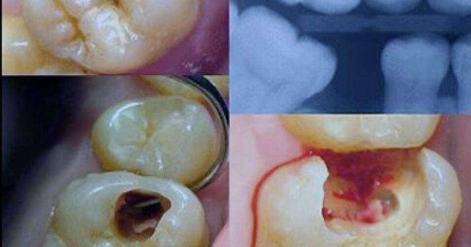 Why tooth extraction is not always the best solution | Lifestyles ...