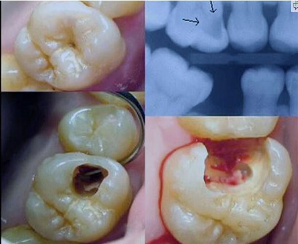 Why tooth extraction is not always the best solution | Lifestyles ...