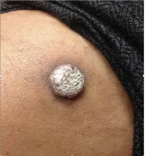 Skin cancers seen on the feet | Foot Health | thenassauguardian.com