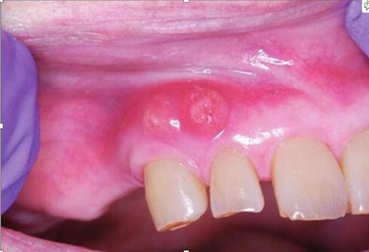Why tooth extraction is not always the best solution | Lifestyles ...