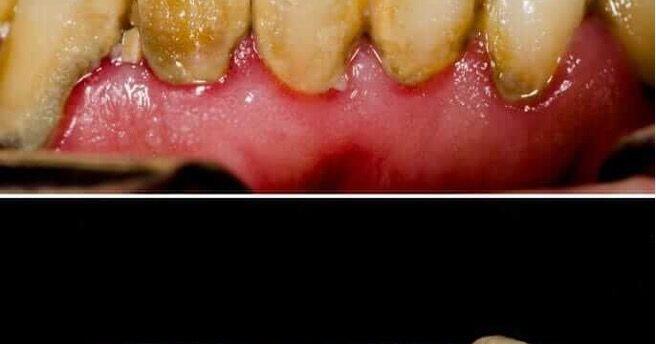 Gum disease and the brain: Your oral health matters | Lifestyles ...
