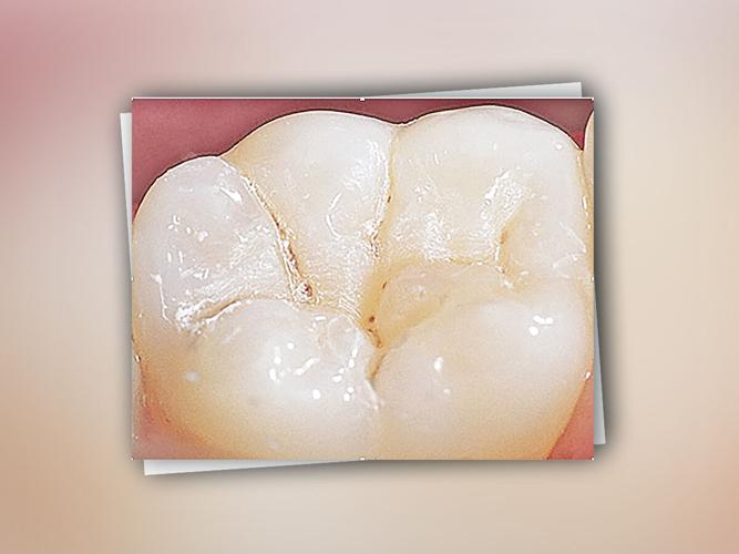 Dental sealants can prevent tooth decay | The Specialist ...