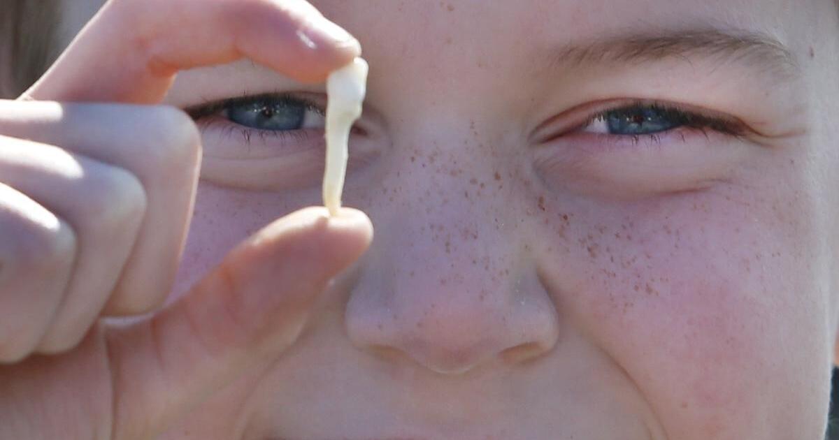 Peterborough boy sets Guinness World Record for longest milk tooth