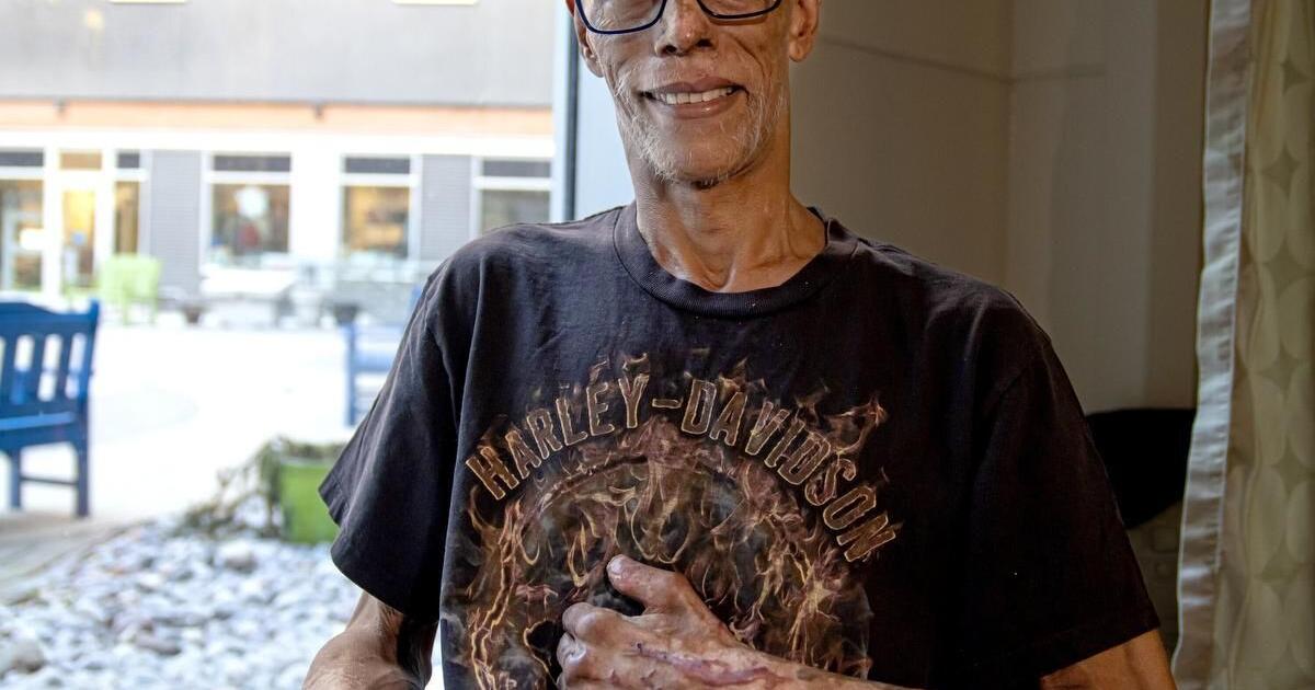 Campbellford man loses fingers, feet after dog bite