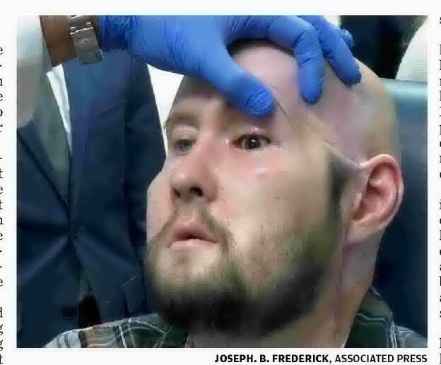 Man receives the first eye transplant, plus a new face | | thesouthern.com