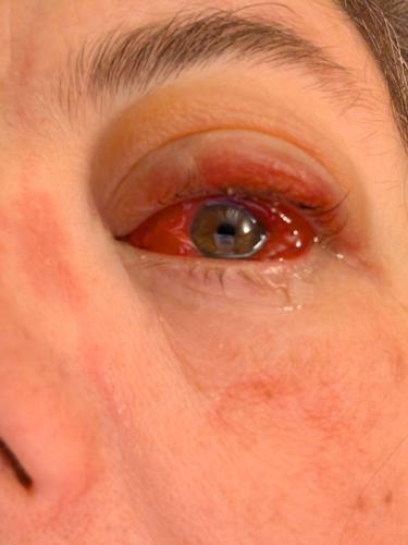 Patients in the dark over pink eye outbreak at King Campus