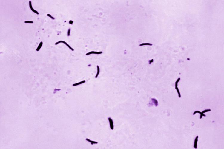 Tuberculosis outbreak hits Labrador weeks after Inuit group decried ...