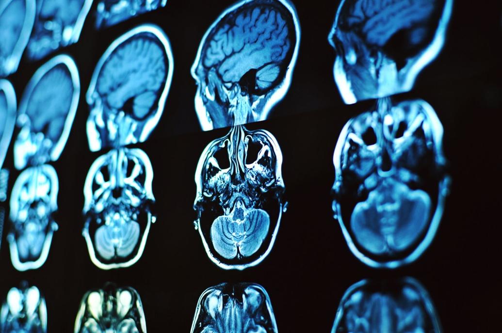 Scientists identify drug that could slow brain cancer