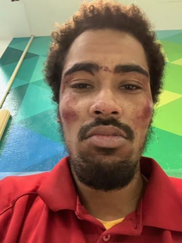 Assault charges withdrawn for epileptic Hamilton man