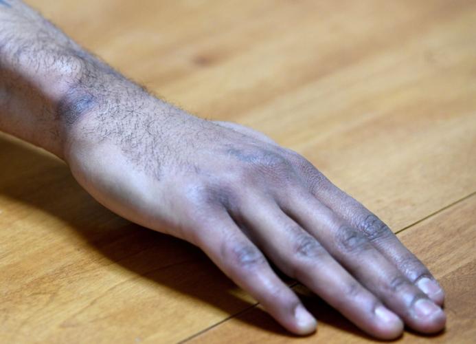 Assault charges withdrawn for epileptic Hamilton man