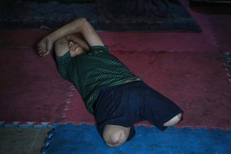 Photos of amputees in Gaza, struggling to survive after losing limbs to ...