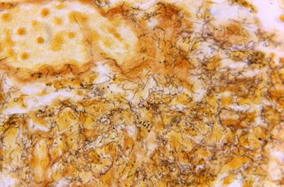 Montreal network to tackle 'explosion' in infections such as syphilis ...
