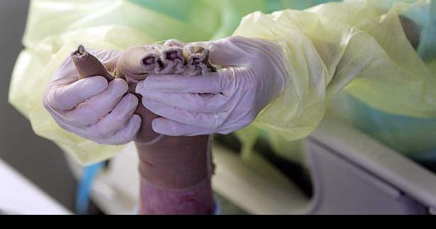 Fashioning 'skin suits' for burn-ravaged bodies