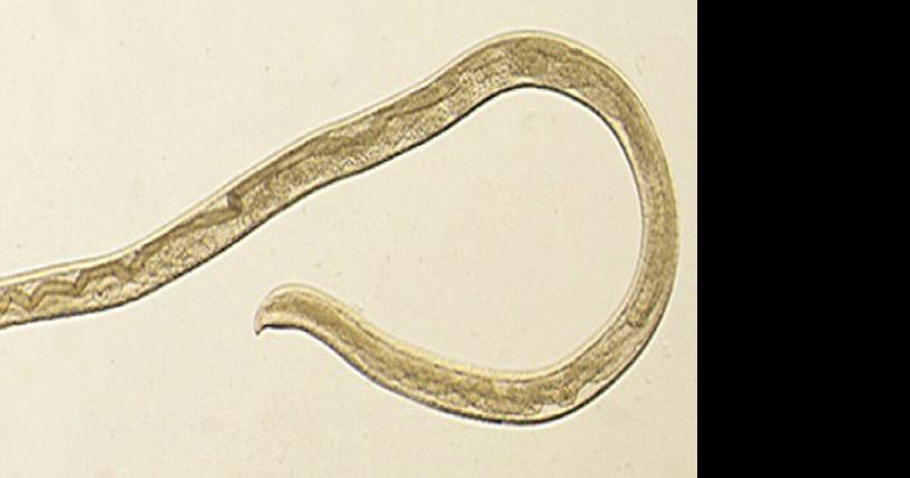 Oregon woman had 14 worms pulled from her eye in first known case of ...