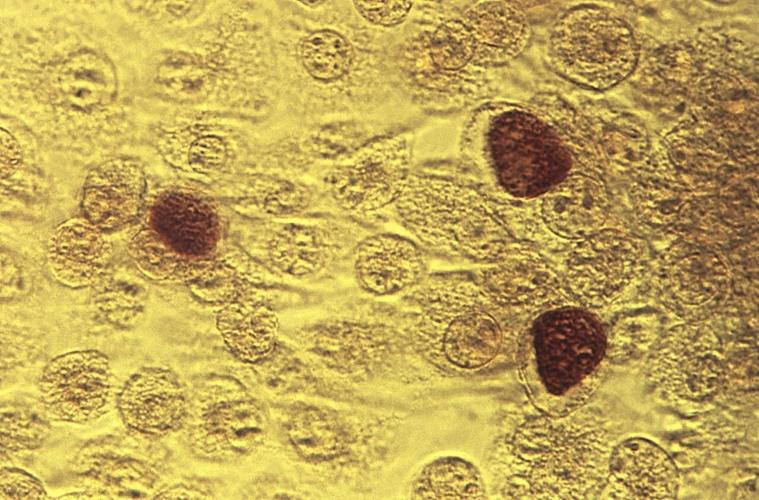STD epidemic slows as new syphilis and gonorrhea cases fall in US