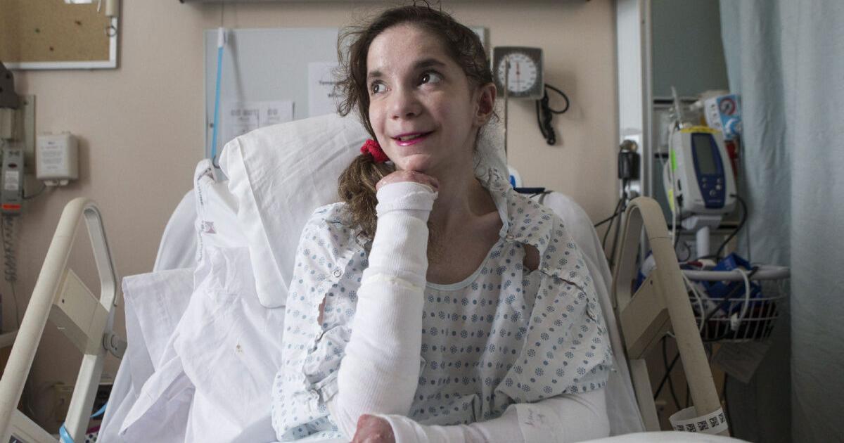 ‘Butterfly’ patient hopes to inspire others with epidermolysis bullosa ...