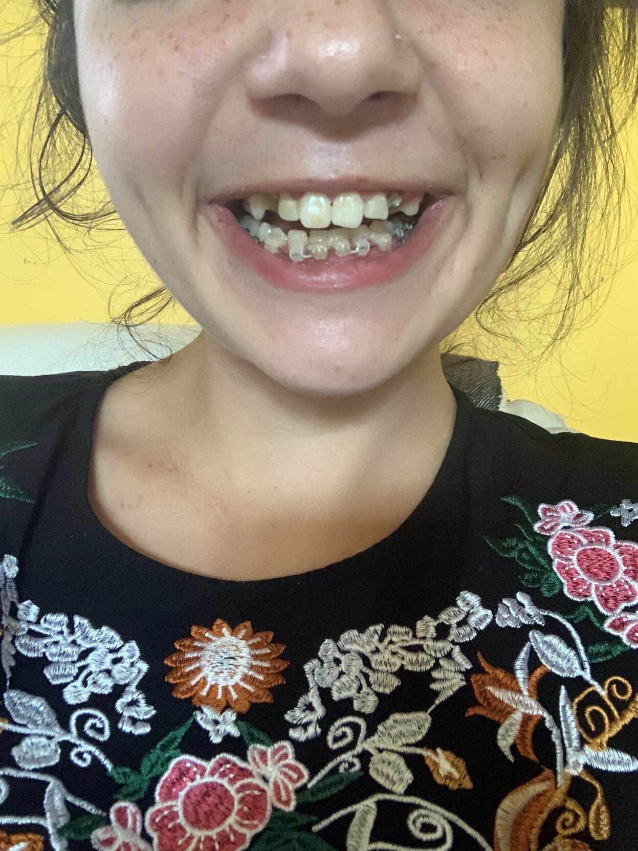 I lost 14 teeth: Canadian dental care access is essential