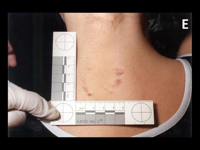 Bite-mark analysis is flawed science. So why was it allowed in court ...