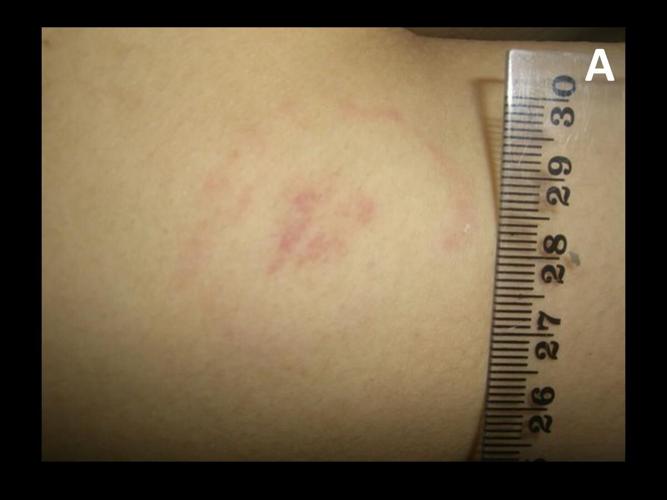 Bite-mark analysis is flawed science. So why was it allowed in court ...