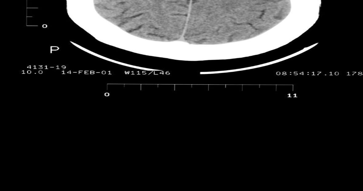 Severe poverty affects children's brain development, study finds