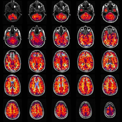 Toronto doctors test brain scan technique that could predict Alzheimer’s