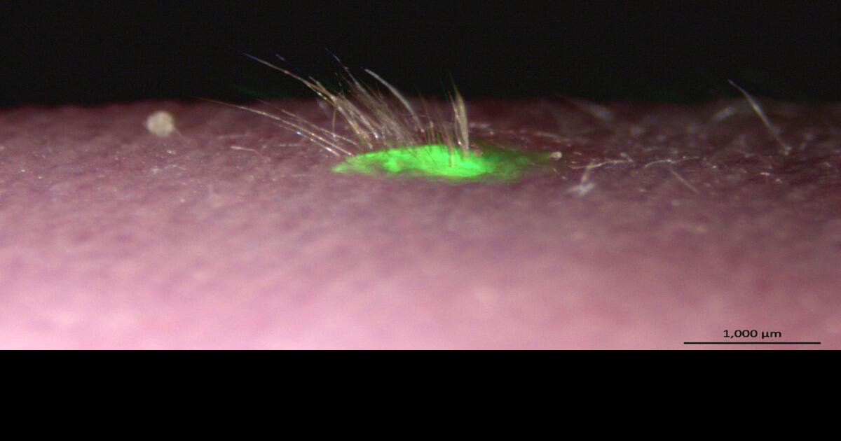 Lab-grown skin could revolutionize skin grafts