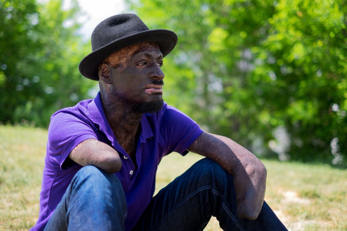 Actor who lost his arms — and nearly his life — in fire reaches new stage