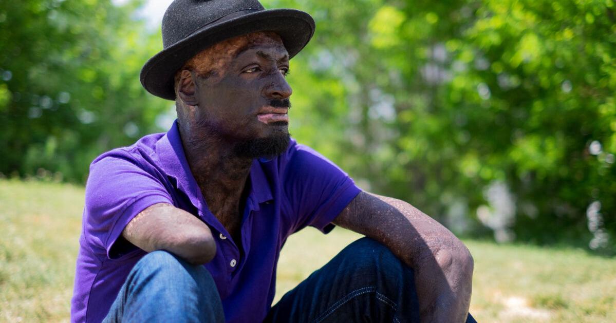 Actor who lost his arms — and nearly his life — in fire reaches new stage