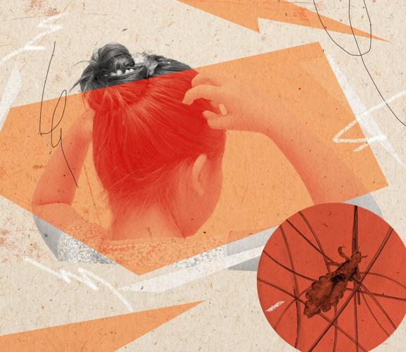 Why drug-resistant ‘super lice’ are here to stay