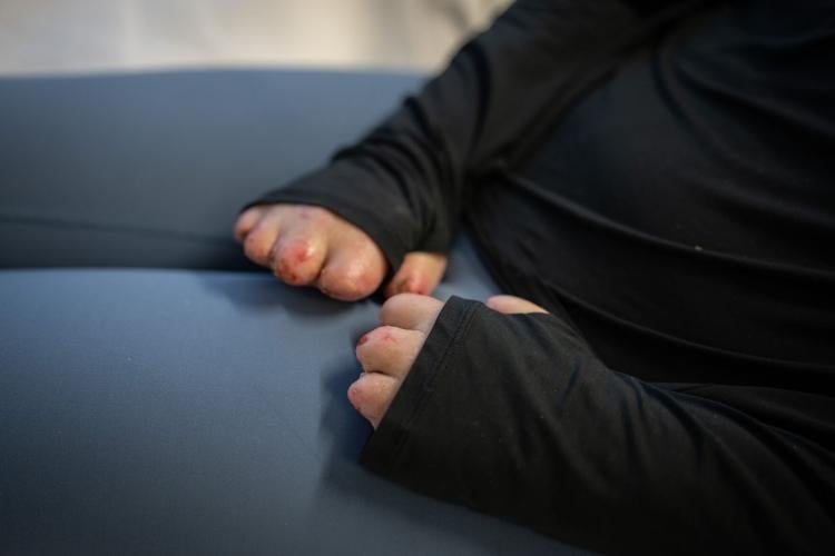 Woman has fingers, toes amputated after botched tummy tuck