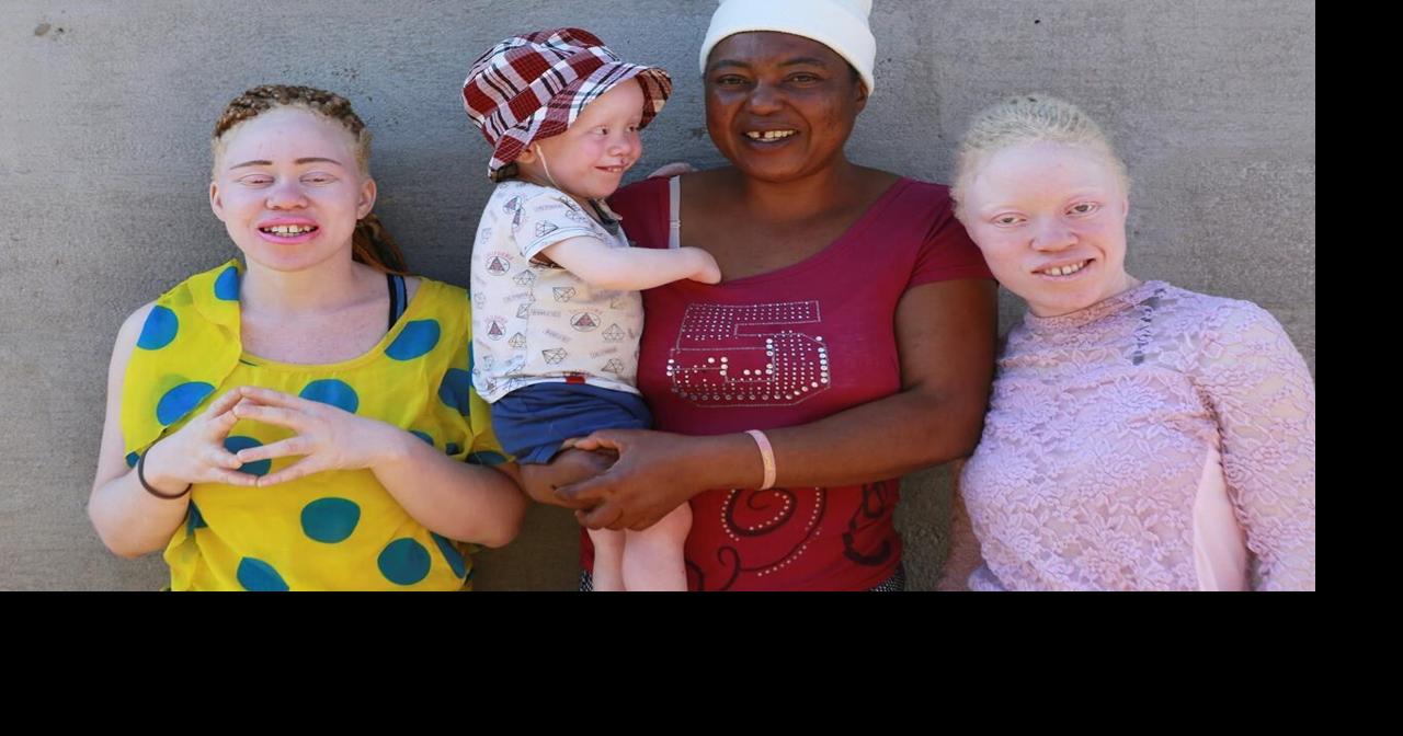 In Zimbabwe, people with albinism struggle against prejudice