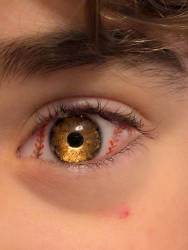 prosthetic eyeball