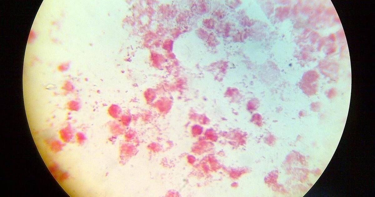 New Brunswick declares gonorrhea outbreak, blames dating apps and ...