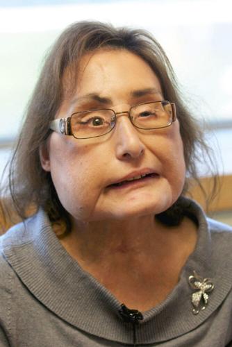 First U.S. face transplant patient meets with donor’s family