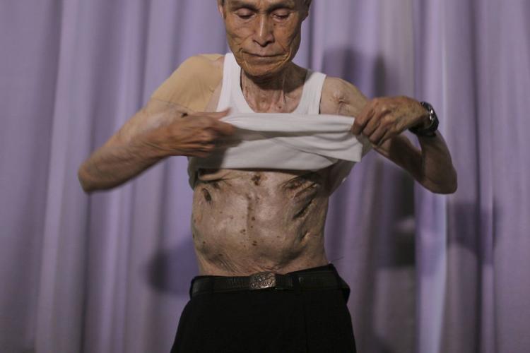 Powerful AP photos show the scars of a survivor of the Nagasaki atomic ...