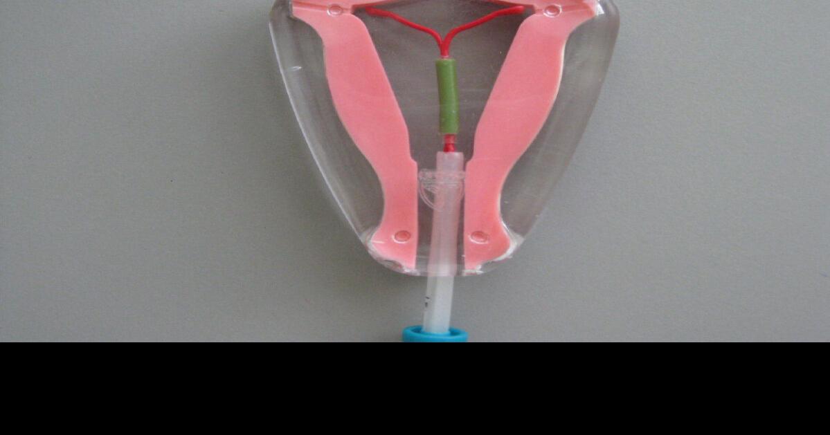 IUDs cut the risk of cervical cancer almost in half: study